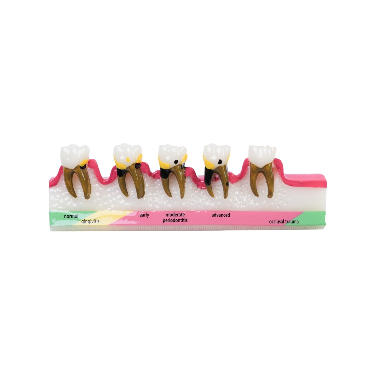 Sarini 1 Piece Of Tooth Periodontal Model, Caries Development Model ...