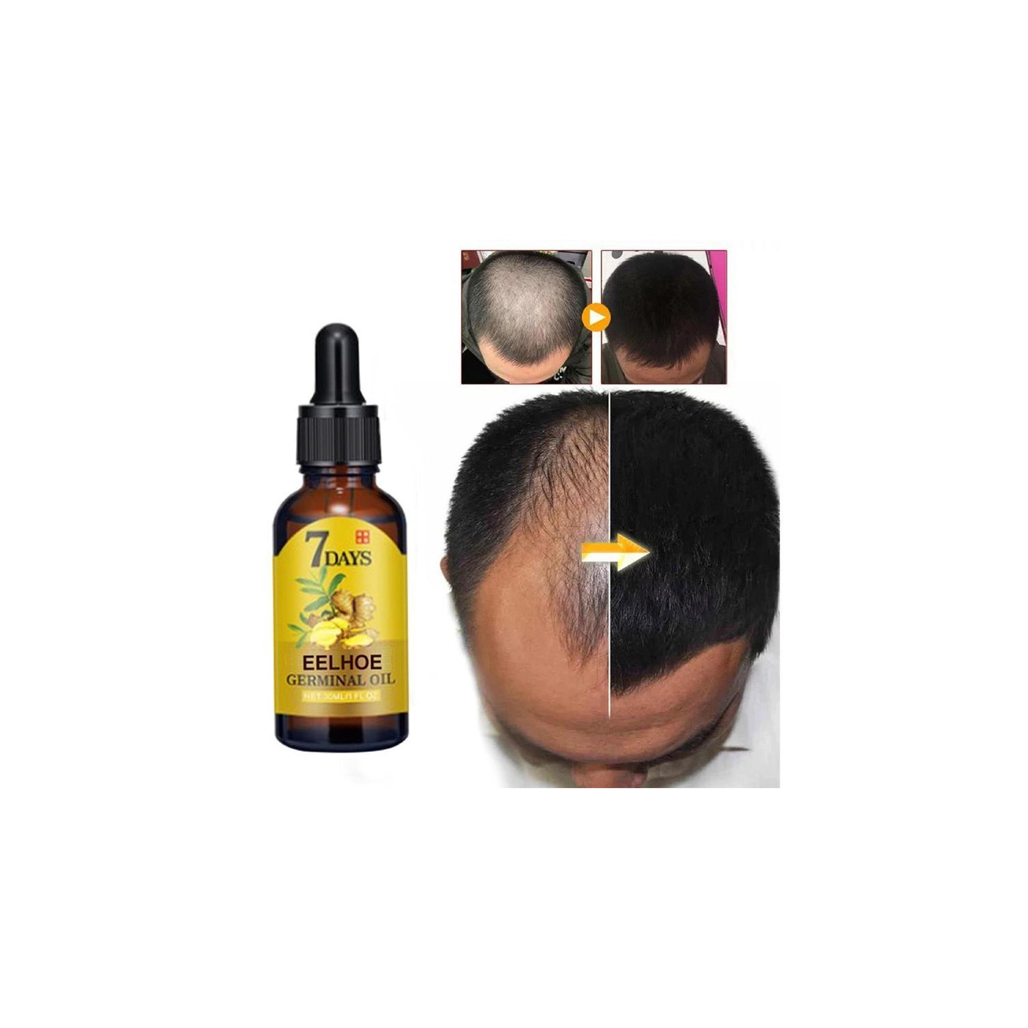 7 Day Fast Hair Growth Oil Ginger Growth Hair Treatment Anti Hair Loss ...